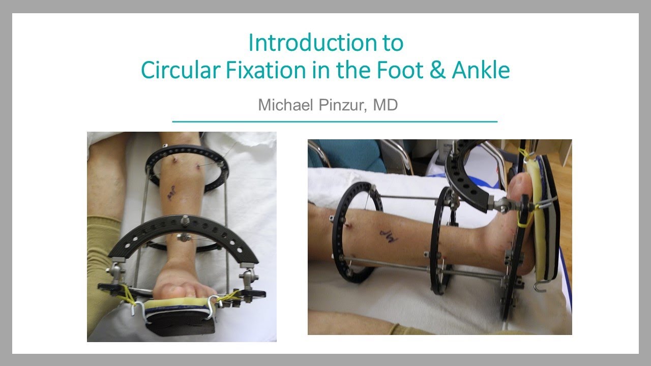 Introduction to Circular Fixation in the Foot & Ankle - YouTube
