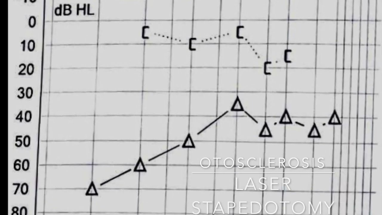 Otosclerosis Audiogram