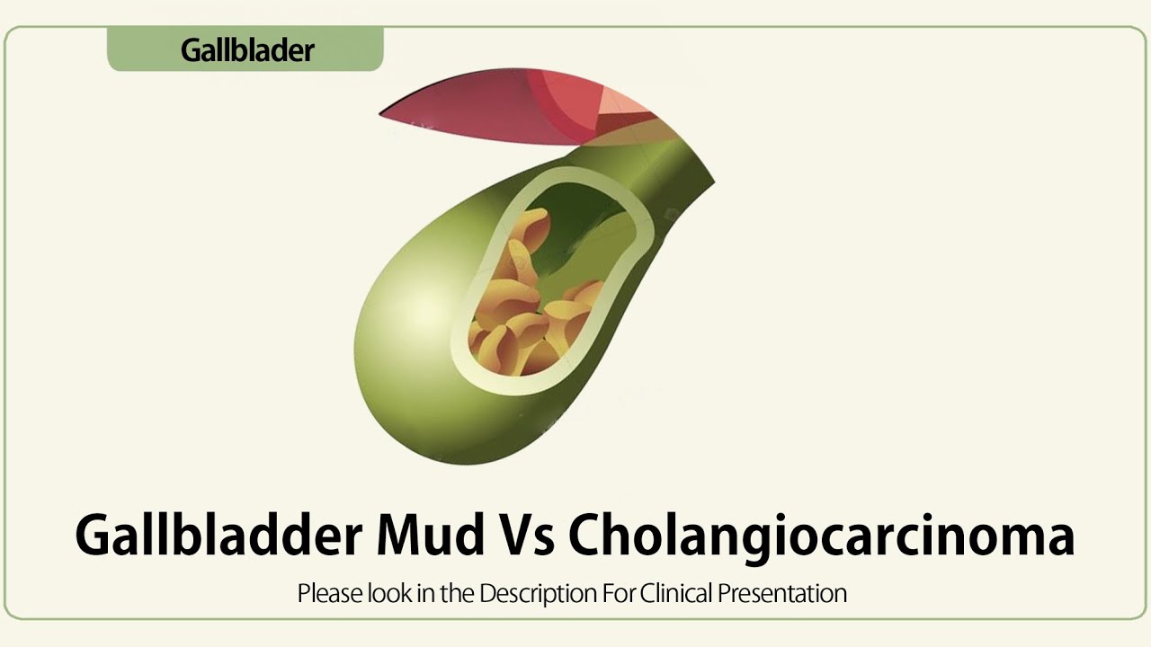 Gallbladder Mud Vs Cholangiocarcinoma - YouTube