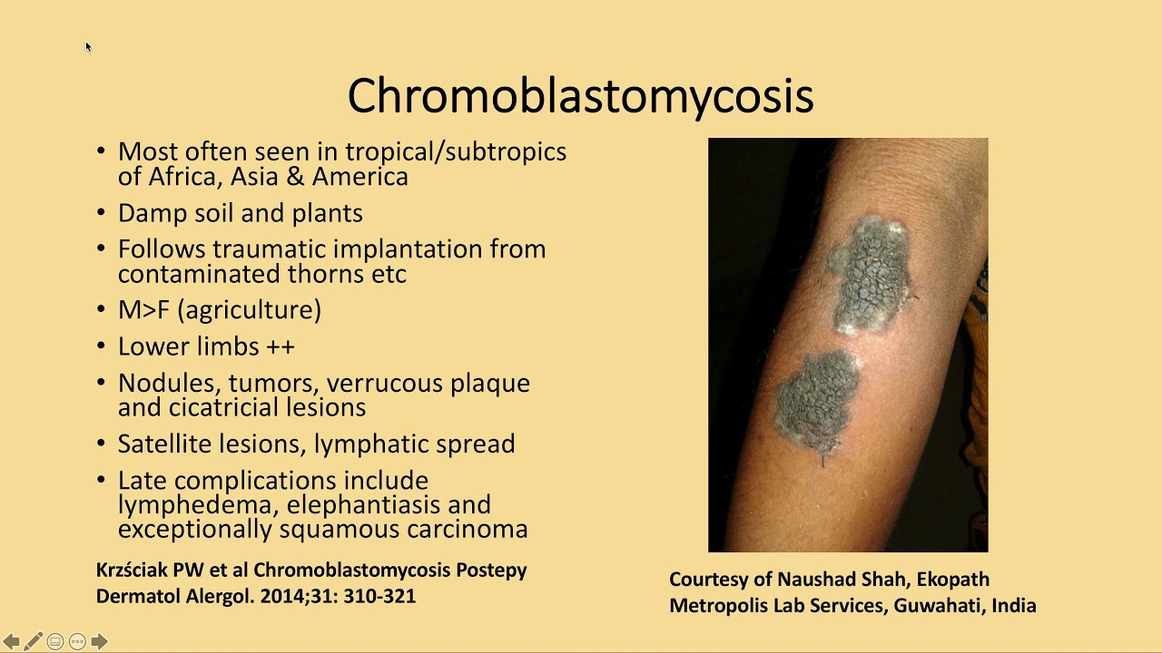 Chromoblastomycosis Phillip H McKee - YouTube