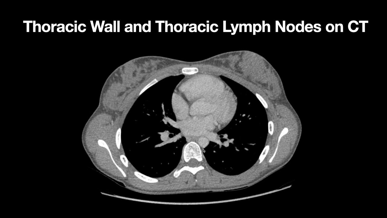 Anatomy of the Thoracic Wall and Thoracic Lymph Node Stations on CT ...