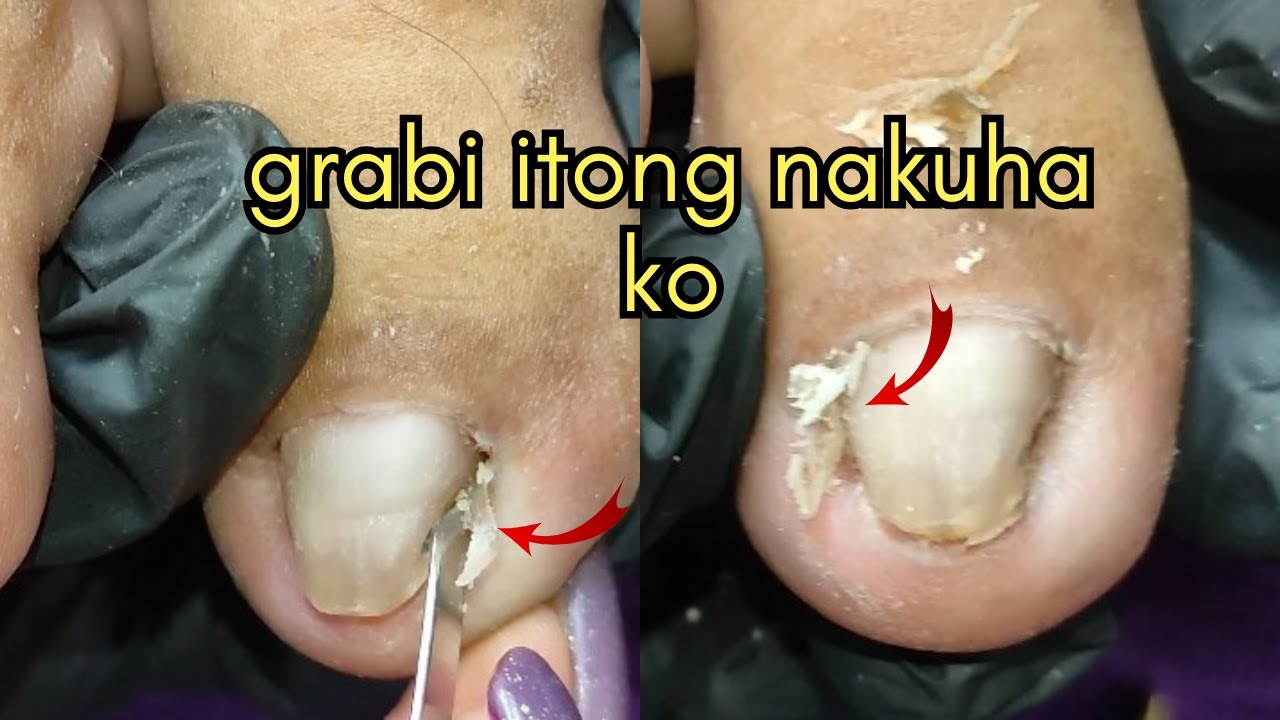 Vlog 950|Dry Skin/Ingrown Removal| PEDICURE 850 - YouTube