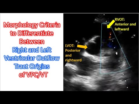 Morphology criteria to differentiate between right and left ventricular ...