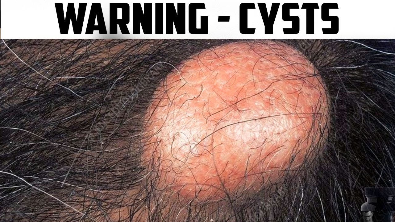 Scalp Cyst Removal! Johnson's Scalp Cyst Removal - YouTube