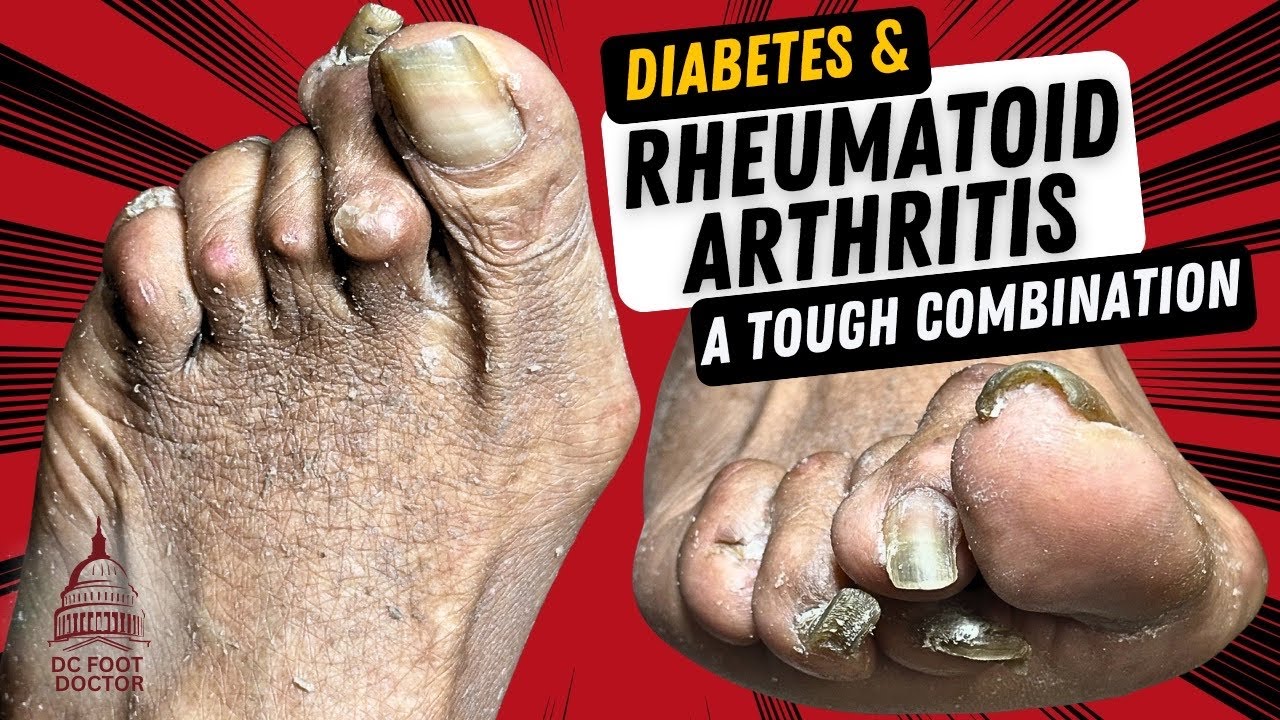 Diabetes & Rheumatoid Arthritis, A Tough Combination - YouTube