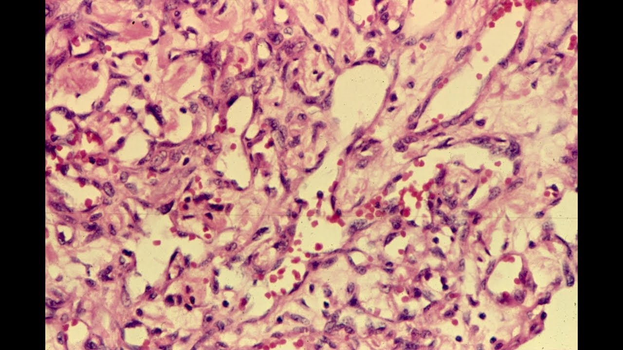 What are Sarcomas? - Pathology mini tutorial - YouTube