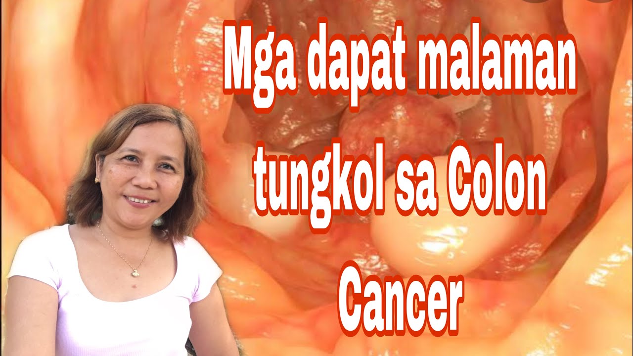 Colon Cancer: Alamin kung Isa Ka sa Kandidato ng Colon Cancer - YouTube