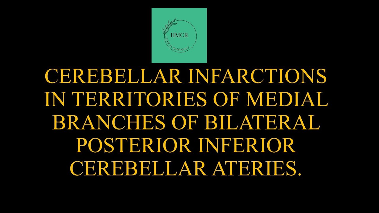 Case # 7 INFARCTIONS IN MEDIAL BRANCHES OF BILATERAL PICA TERRITORIES ...