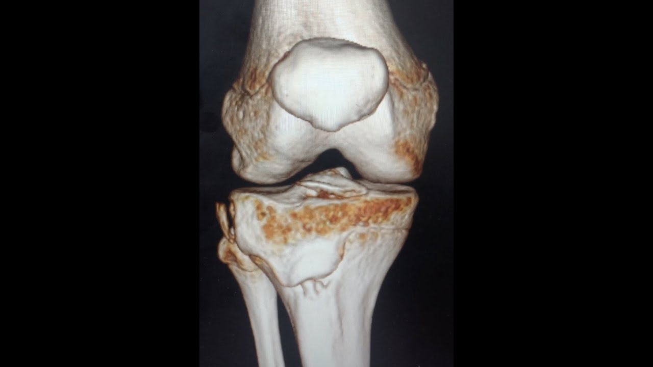ACL anteromedial tibial spine avulsion fixation + Segond's fracture ...
