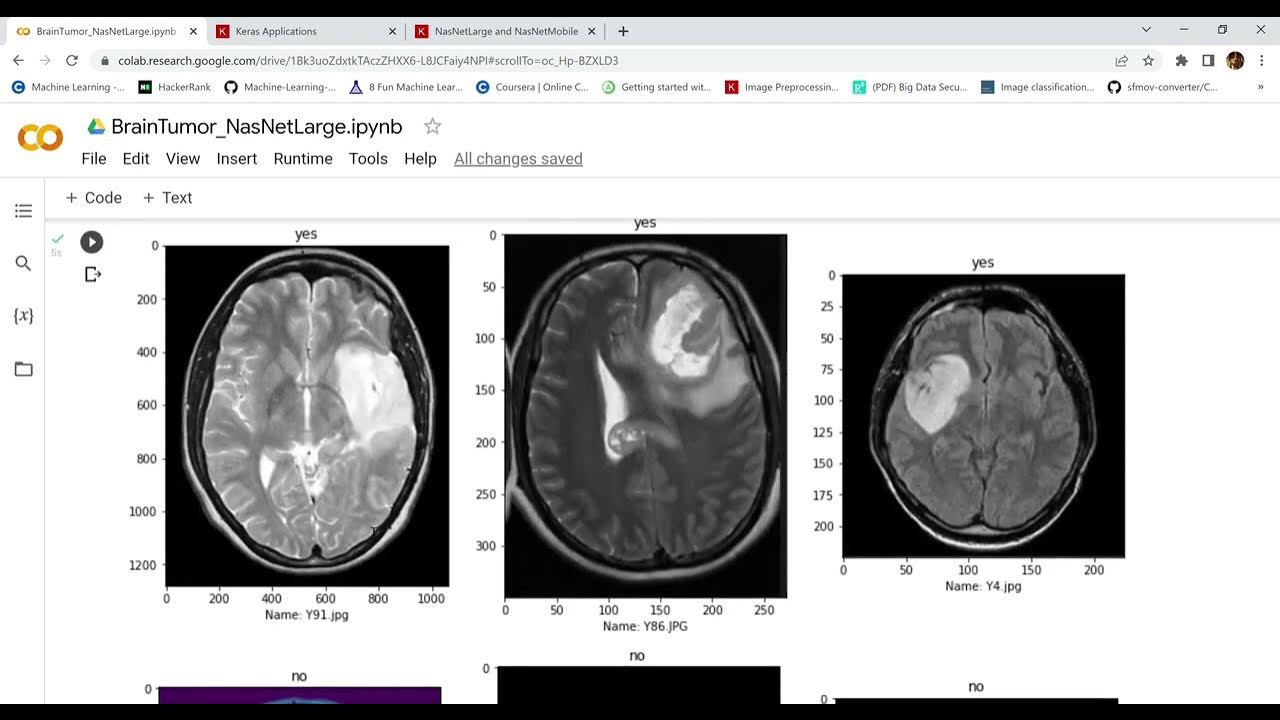 Transfer Learning By PreTrained Network || Brain_Tumor Detection ...