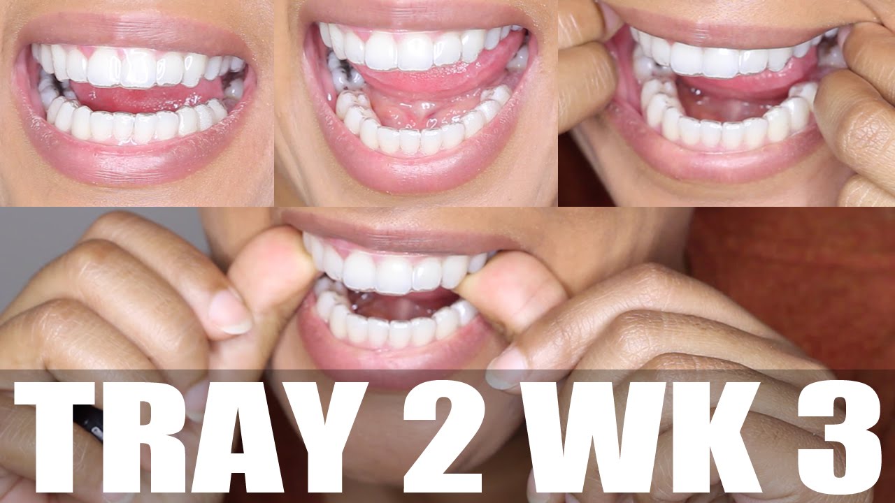 WK 3 (Clear Braces): Tray 1 Update + Tray 2 Try-on | SmileDirectClub ...