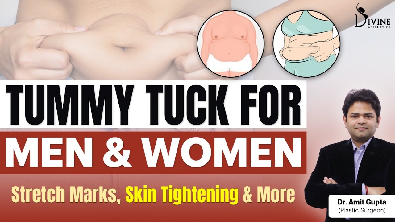 Tummy Tuck for Men & Women: Stretch Marks, Skin Tightening & More ...