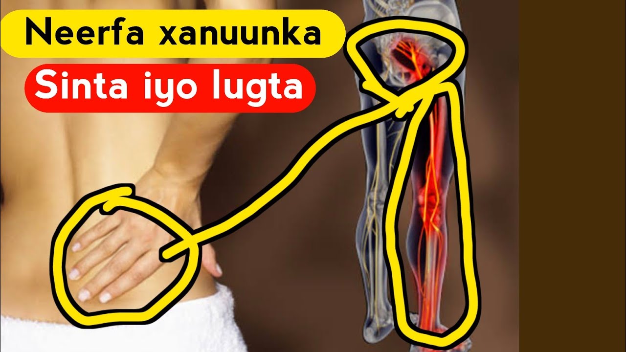 Xanuunka Neerfaha dhabarka qeeybta Hoose ( sinta ) ilaa lugta Sida loo ...