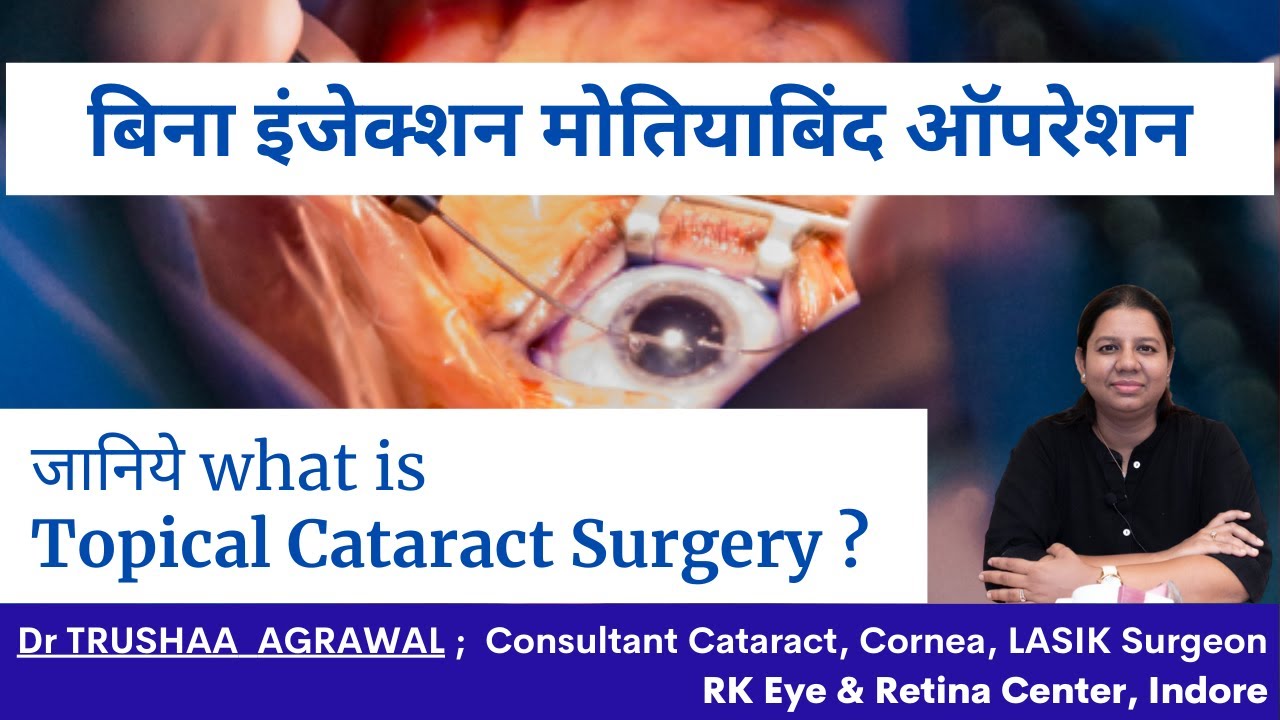 बिना इंजेक्शन मोतियाबिंद ऑपरेशन ! Topical cataract surgery. Painless ...