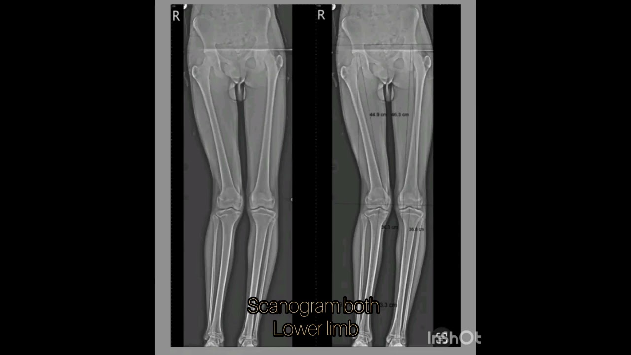 Xray Scanogram Youtube Scanogram Both Lower Limb🏥 . . #xray_doctor
