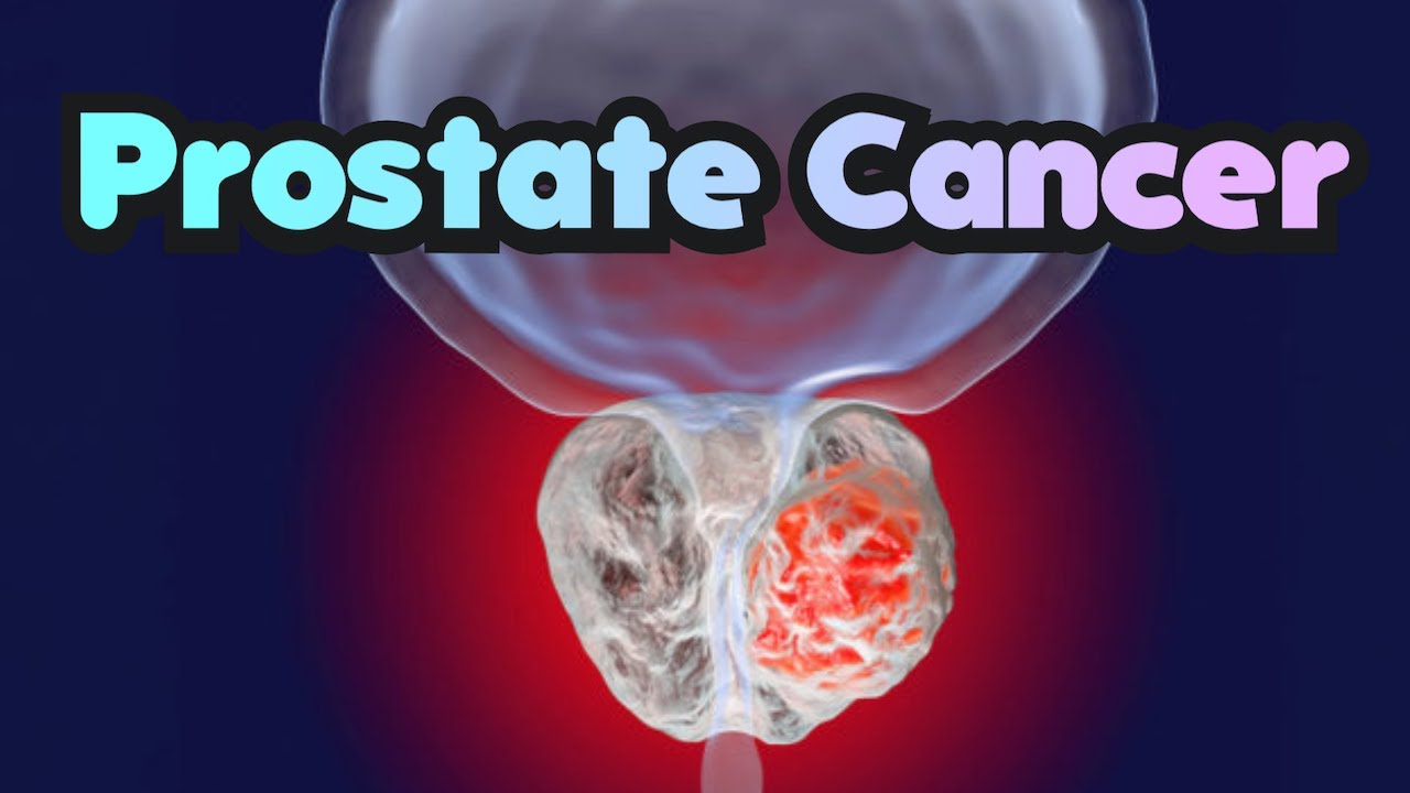 Prostate Cancer - CRASH! Medical Review Series - YouTube