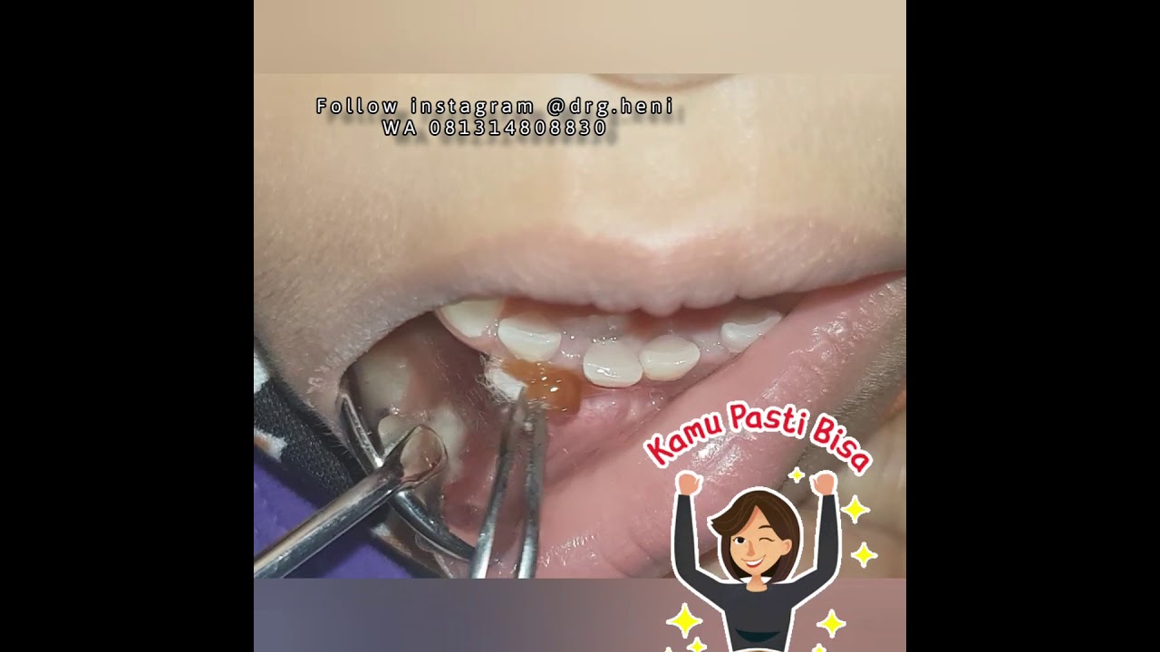 cabut gigi susu 🥰🥰 || drg heni - YouTube