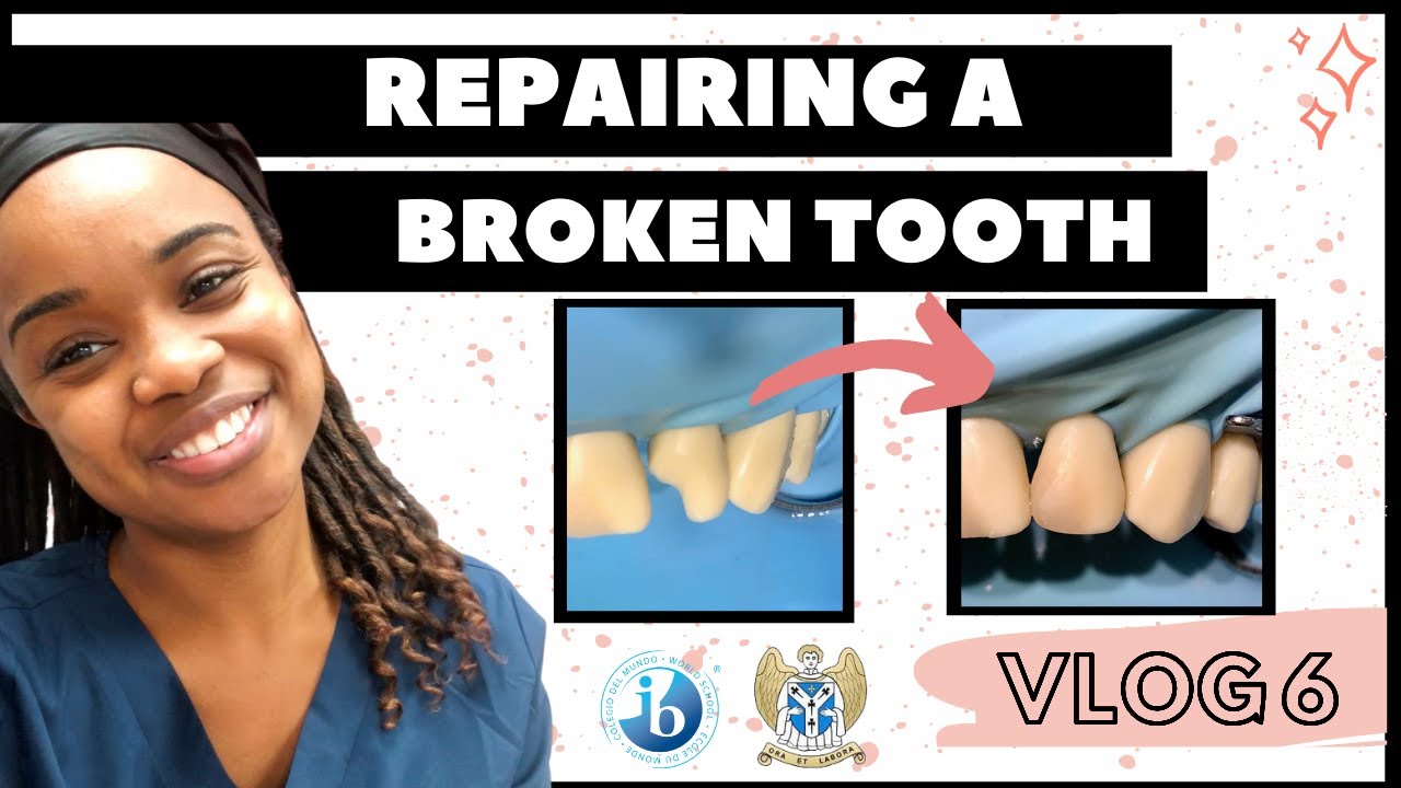 HOW TO FIX A BROKEN TOOTH | Anterior Composite Restoration | DENTAL ...