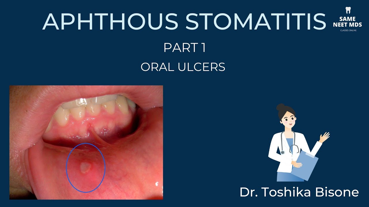 Aphthous stomatitis | Part 1 | Oral ulcers - YouTube