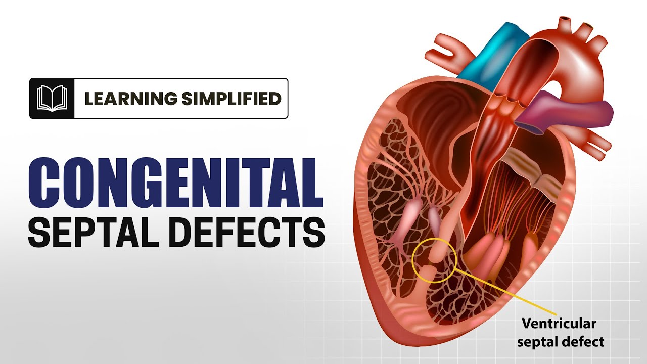 Congenital Septal Defects Easy Explanation | PrepLadder NEET-PG - YouTube