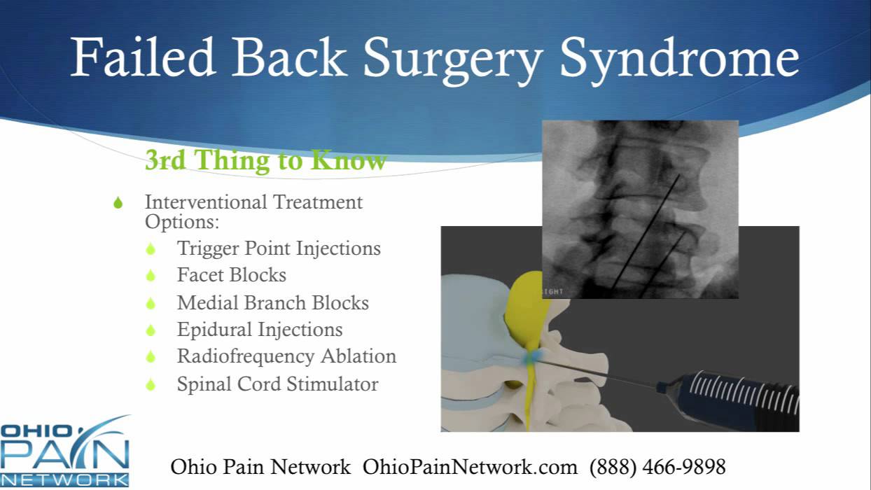 Five Things to Know About Failed Back Surgery Syndrome (888) 466-9898 ...