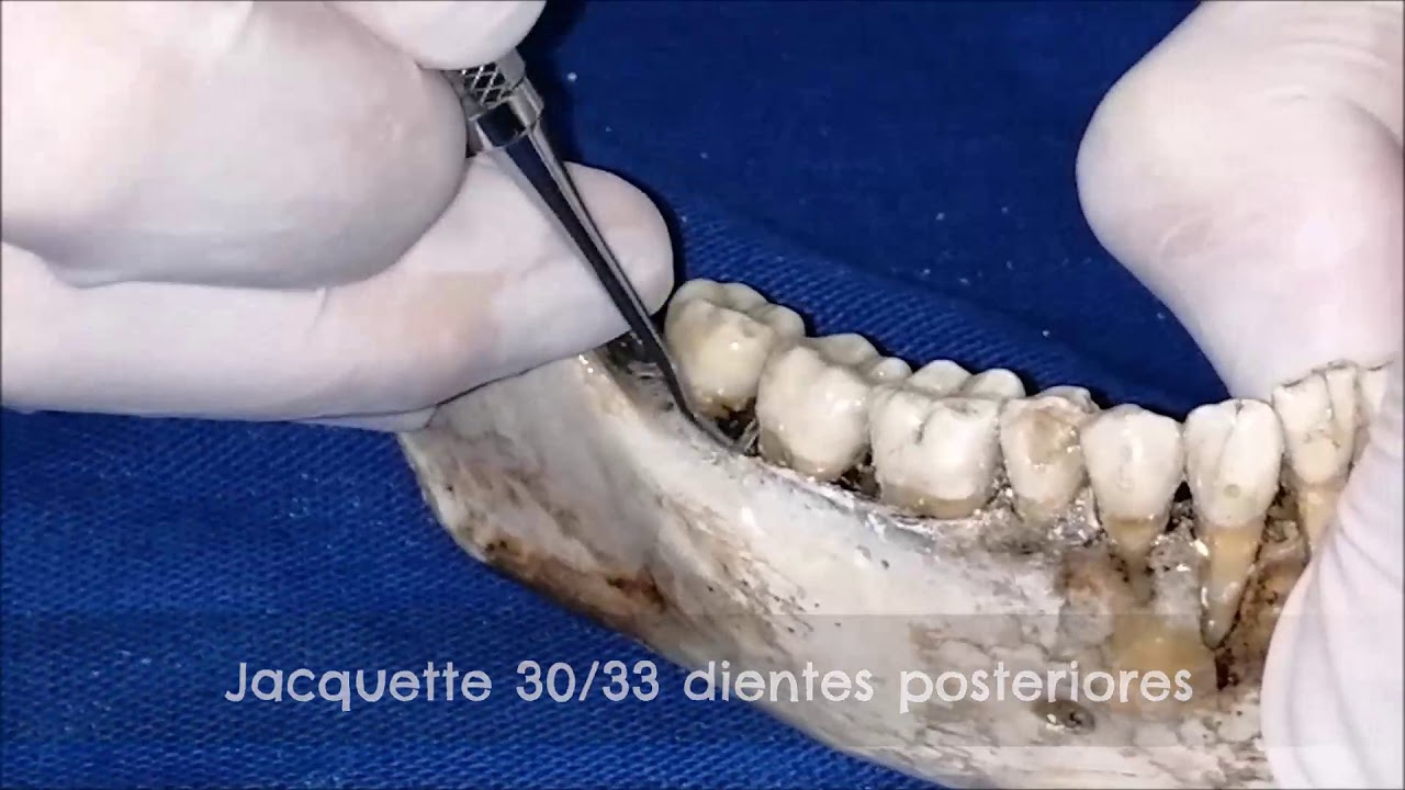 Raspado y alisado radicular y cálculo supragingival - YouTube