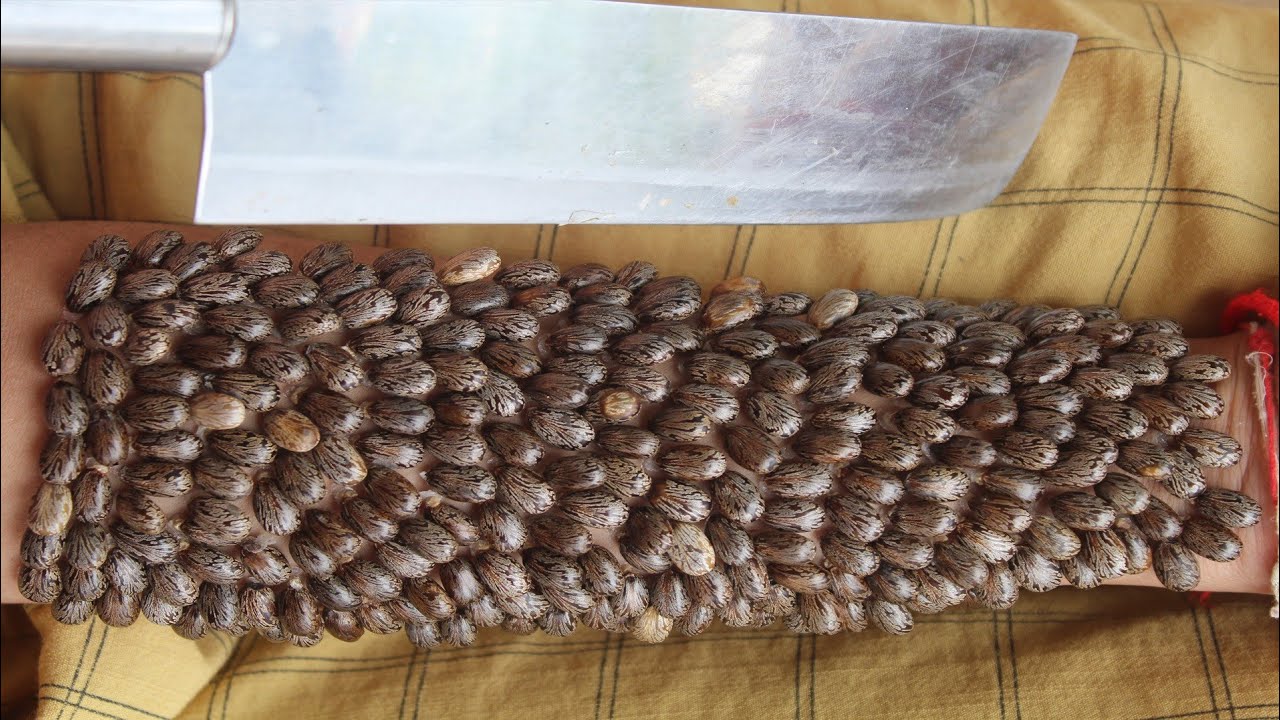 We Help Remove Million Big Ticks on Hand Humans With Knife #Eps-79 ...