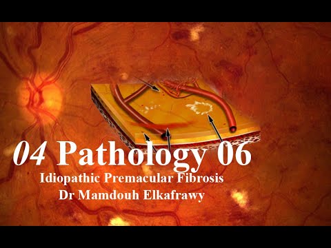 04 Retinal Pathology 06 #Elkafrawy #pathology #باثولوجي#الكفراوي ...