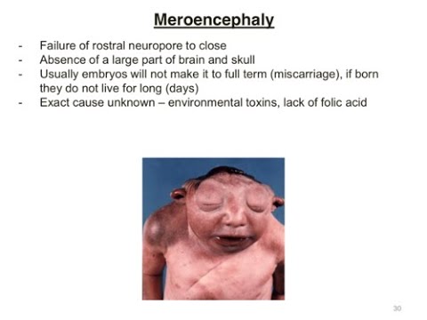 Meroencephaly / meroanencephaly ; Definition, Causes, Diagnosis and ...