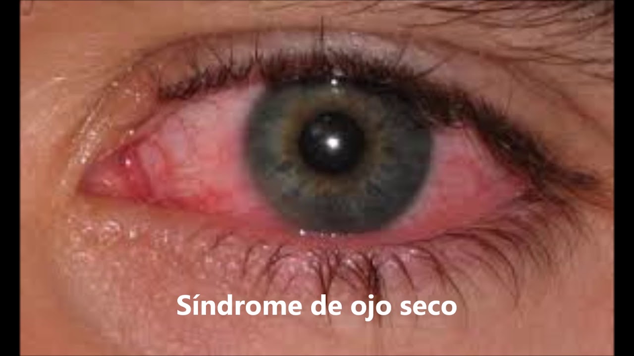 3 causas comunes de ojos rojos - YouTube