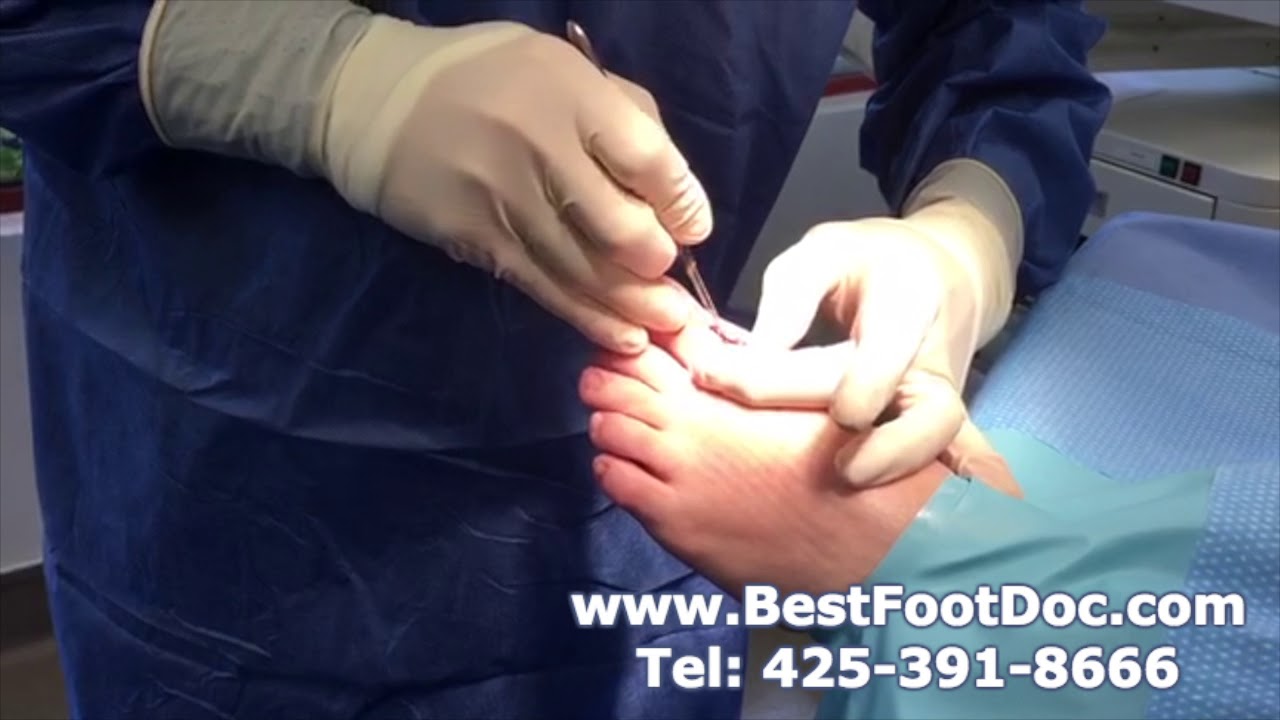 Cartiva Implant Surgery for Hallux Limitus - Live Surgery - YouTube