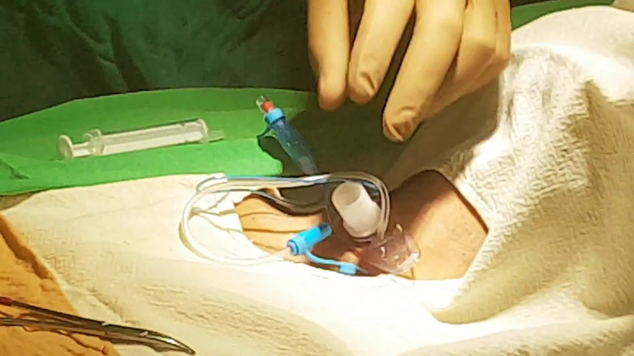 Percutaneous tracheostomy in 2 mins II Tracheostomy Procedure - YouTube