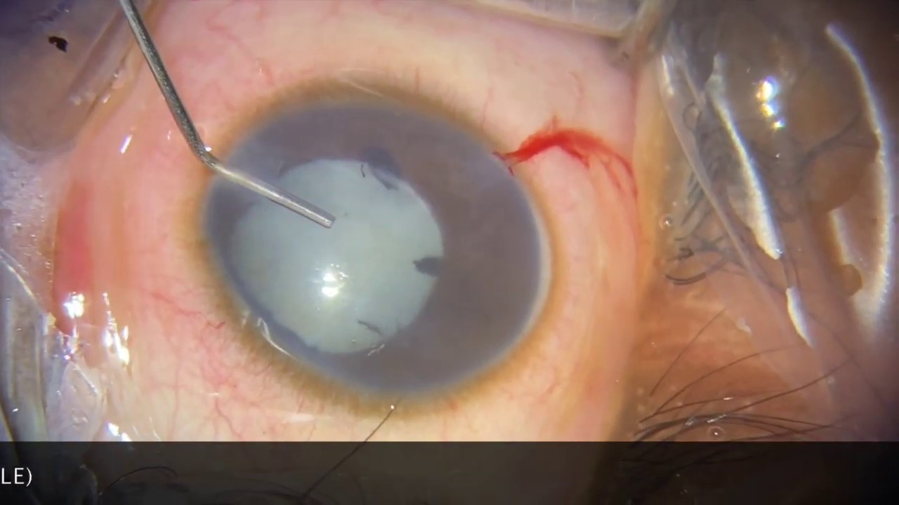RETINA 10/Bilateral ped RRD - PRV C++++ - YouTube
