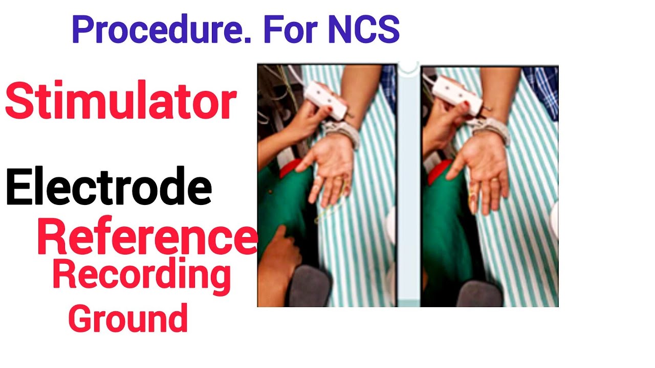 Procedure for nerve conduction study, stimulator,active electrode ...