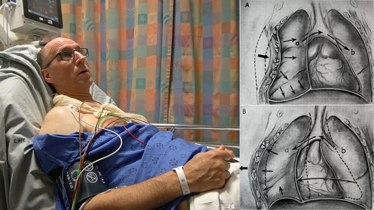 My Dad fell off a ladder and broke 10 ribs (has a Flail Chest) - YouTube