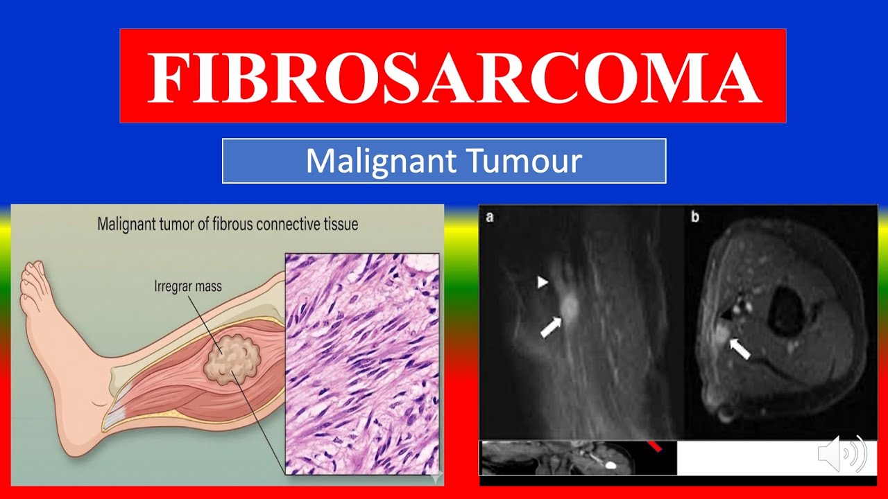 FIBROSARCOMA - Definition, types, causes, pathophysiology, symptoms ...