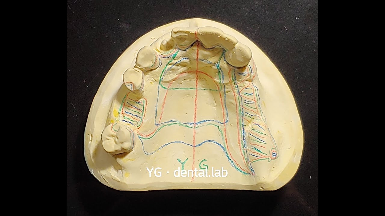 4. 특강 Wrought wire를 이용한 Framework (교합제 제작)ㆍ126(YG Dental Lab) - YouTube