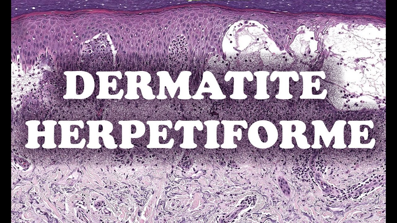 LA DERMATITE HERPETIFORME - PATHOLOGIE - YouTube