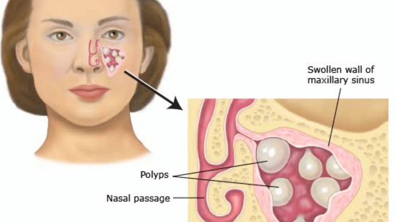 Nasal Polyps Youtube