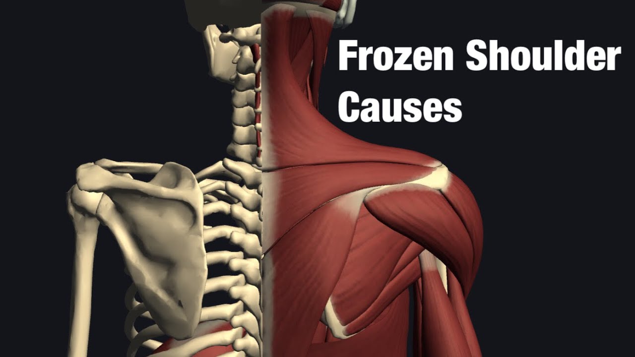 4 muscles that can be cause for frozen shoulder - YouTube