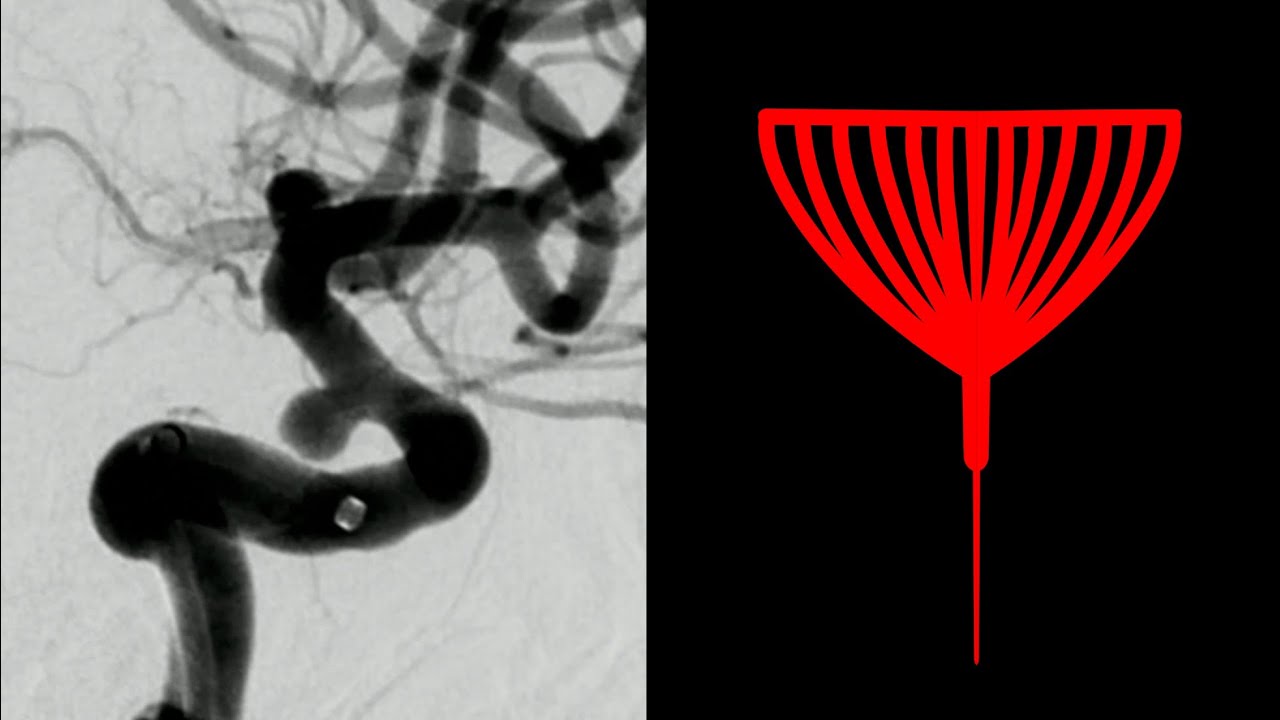 (English) Saccular aneurysm of the left ICA. Intrasaccular flow ...