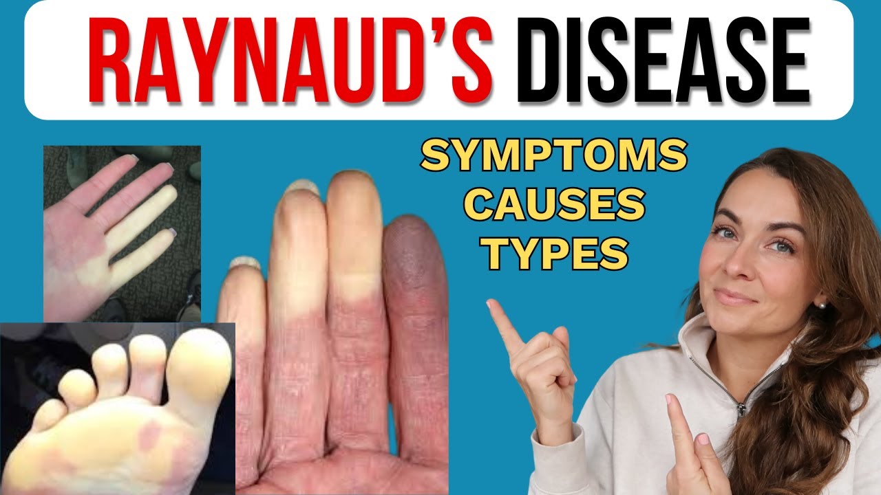 What is Raynaud's Syndrome? Symptoms, Causes, and Types Explained - YouTube