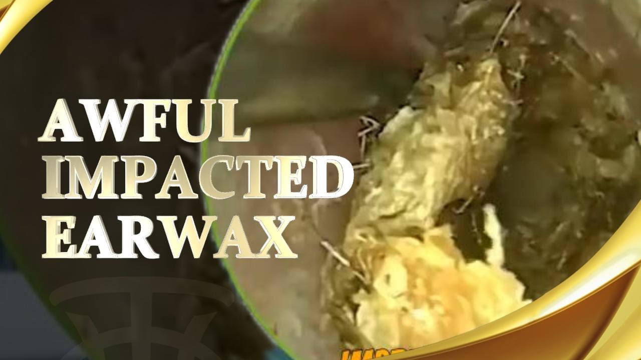 AWFUL IMPACTED EAR WAX #earwaxremoval #earwax #asmrcleaning #impressive ...