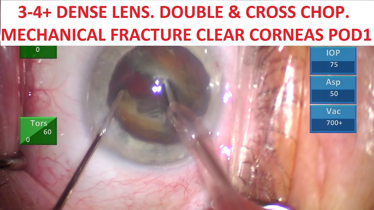 TBWTDCS #165: 3-4+ Dense Lens. Double & Cross Chop. Mechanical ...