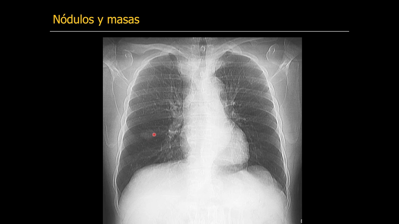 Clase Rx-Radiografia de tórax patológico-IDEAL PARA ESTUDIANTES Parte 3 ...
