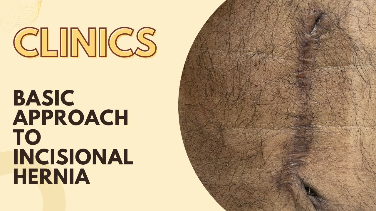 BASIC APPROACH TO INCISIONAL HERNIA - YouTube