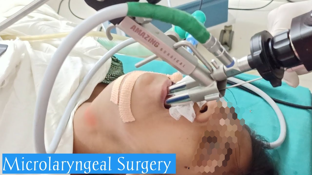 Microlaryngeal Surgery (MLS)#3, By Dr Ambuj Pandey in Kalyanam Hospital ...