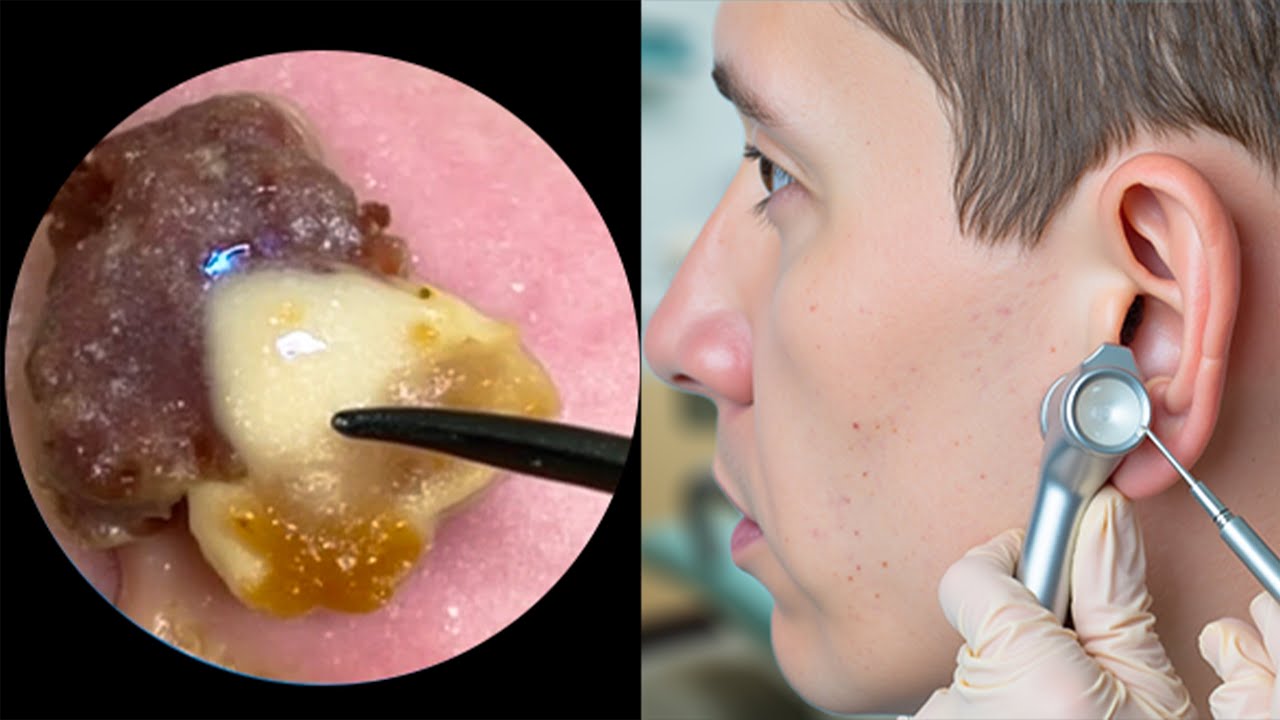 Thick Ear Wax Plug + Full Eardrum Peel – Deep Ear Wax Removal! / Thick ...
