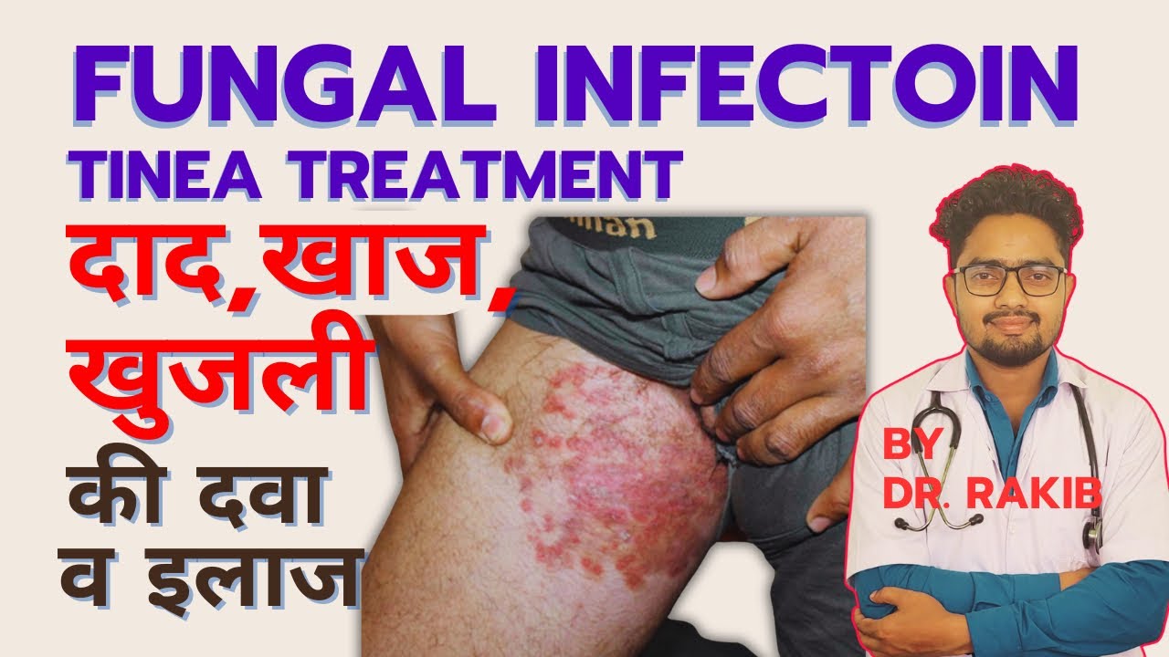 TINEA CORPORIS||FUNGAL INFECTION TREATMENT|दाद खाज खुजली की दवा|TINEA ...