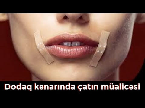 Dodaq kənarında çatın müalicəsi